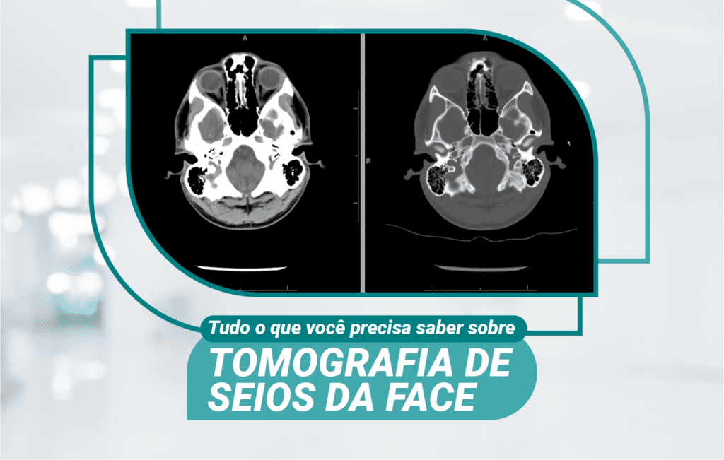 Tudo o que você precisa saber sobre Tomografia de seios da face